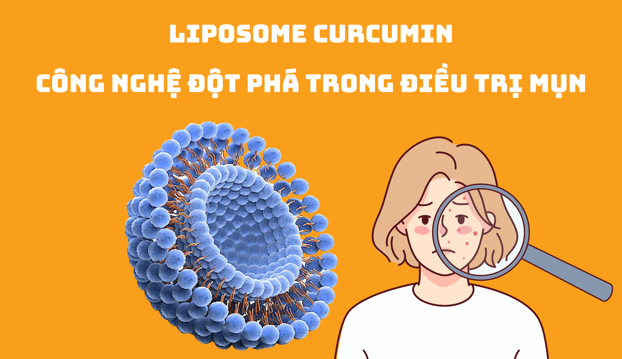 Liposome Curcumin: Công nghệ đột phá trong điều trị mụn